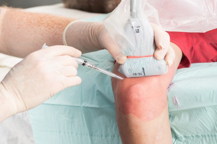 PONCTION COUDE : REDSONOGUIDE – echoguidance