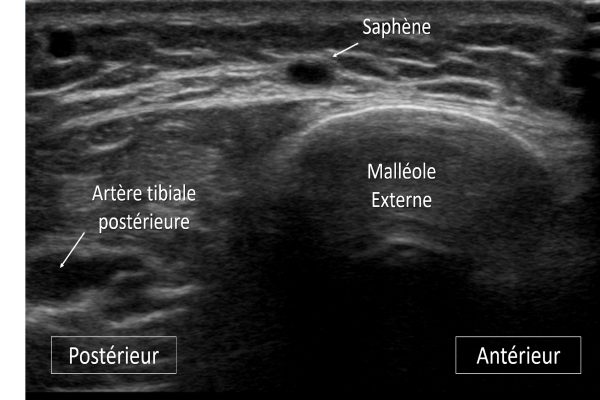 ACCÈS VASCULAIRES : REDSONOGUIDE – echoguidance