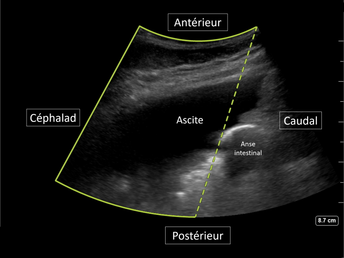 PONCTION ASCITE : REDSONOGUIDE – echoguidance
