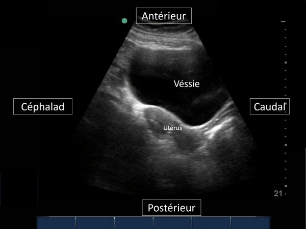 PONCTION SUS-PUBIENNE : REDSONOGUIDE – echoguidance